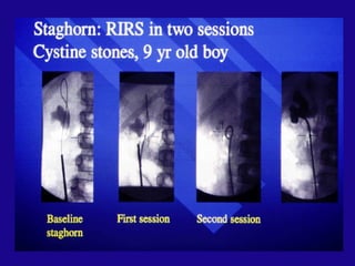 Retrograde Intrarenal Ureteroscopic Surgery (RIRS) | PPT