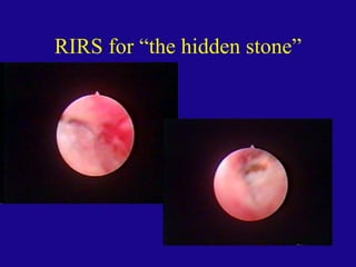 Retrograde Intrarenal Ureteroscopic Surgery (RIRS) | PPT