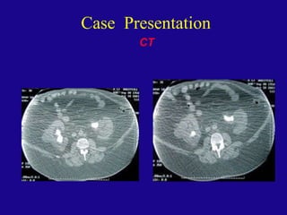 Retrograde Intrarenal Ureteroscopic Surgery (RIRS) | PPT