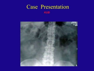 Retrograde Intrarenal Ureteroscopic Surgery (RIRS) | PPT