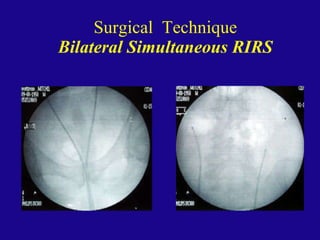 Retrograde Intrarenal Ureteroscopic Surgery (RIRS) | PPT