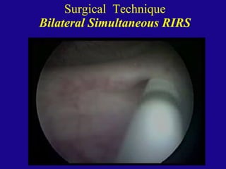 Retrograde Intrarenal Ureteroscopic Surgery (RIRS) | PPT