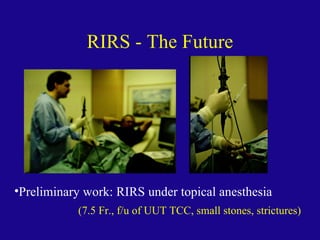 Retrograde Intrarenal Ureteroscopic Surgery (RIRS) | PPT