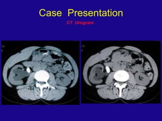 Retrograde Intrarenal Ureteroscopic Surgery (RIRS) | PPT