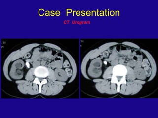 Retrograde Intrarenal Ureteroscopic Surgery (RIRS) | PPT