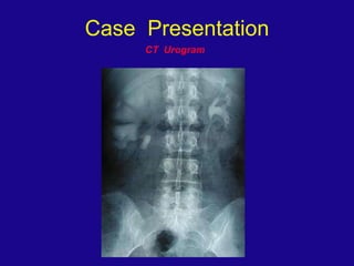 Retrograde Intrarenal Ureteroscopic Surgery (RIRS) | PPT