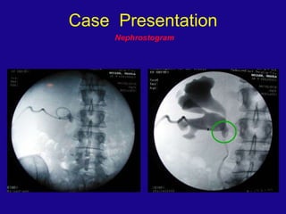 Retrograde Intrarenal Ureteroscopic Surgery (RIRS) | PPT