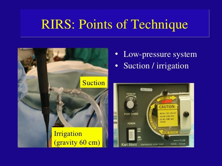 Retrograde Intrarenal Ureteroscopic Surgery (RIRS)