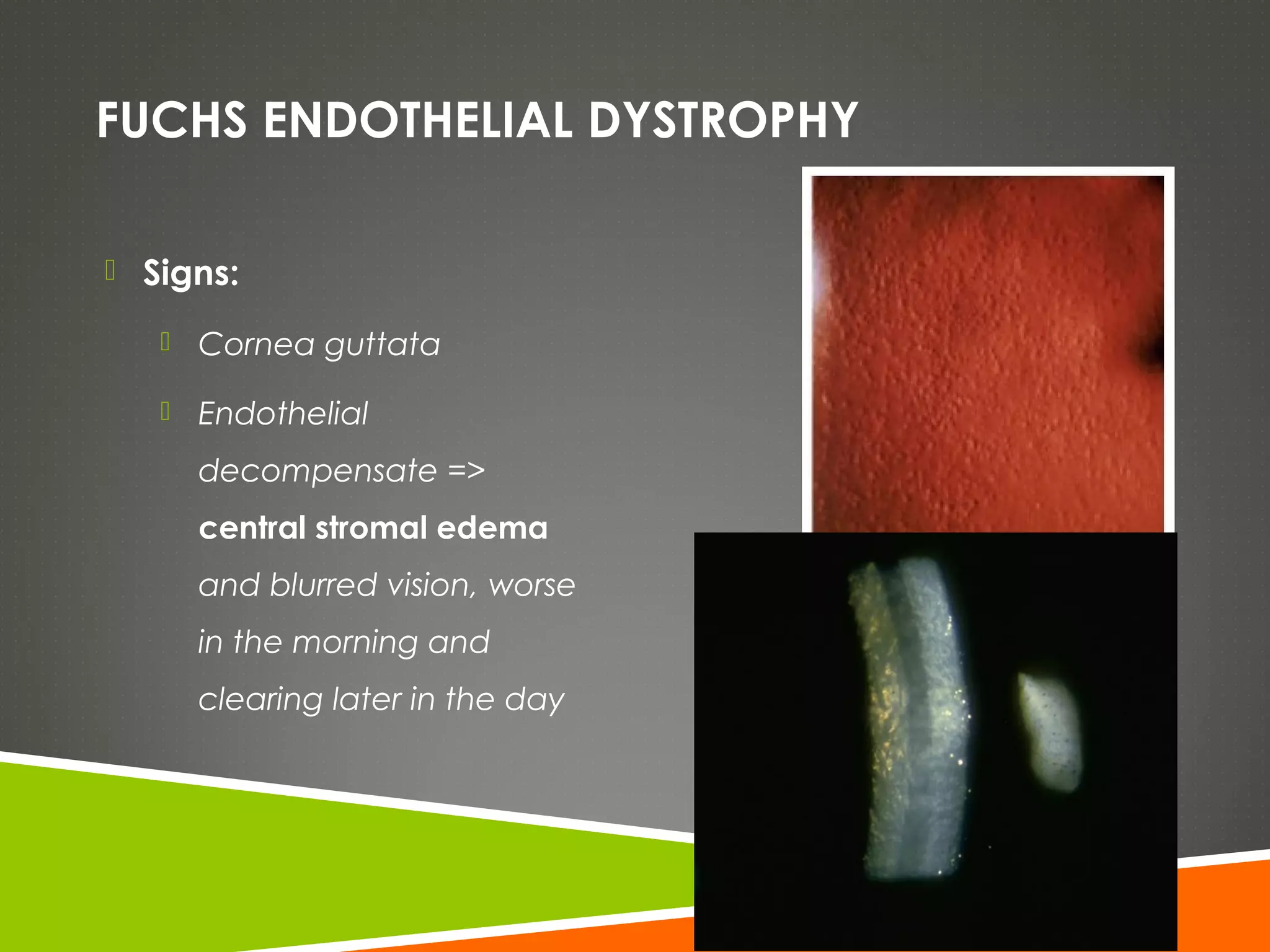 Fuchs dystrophy and pseudophakic bullous keratopathy | PPT