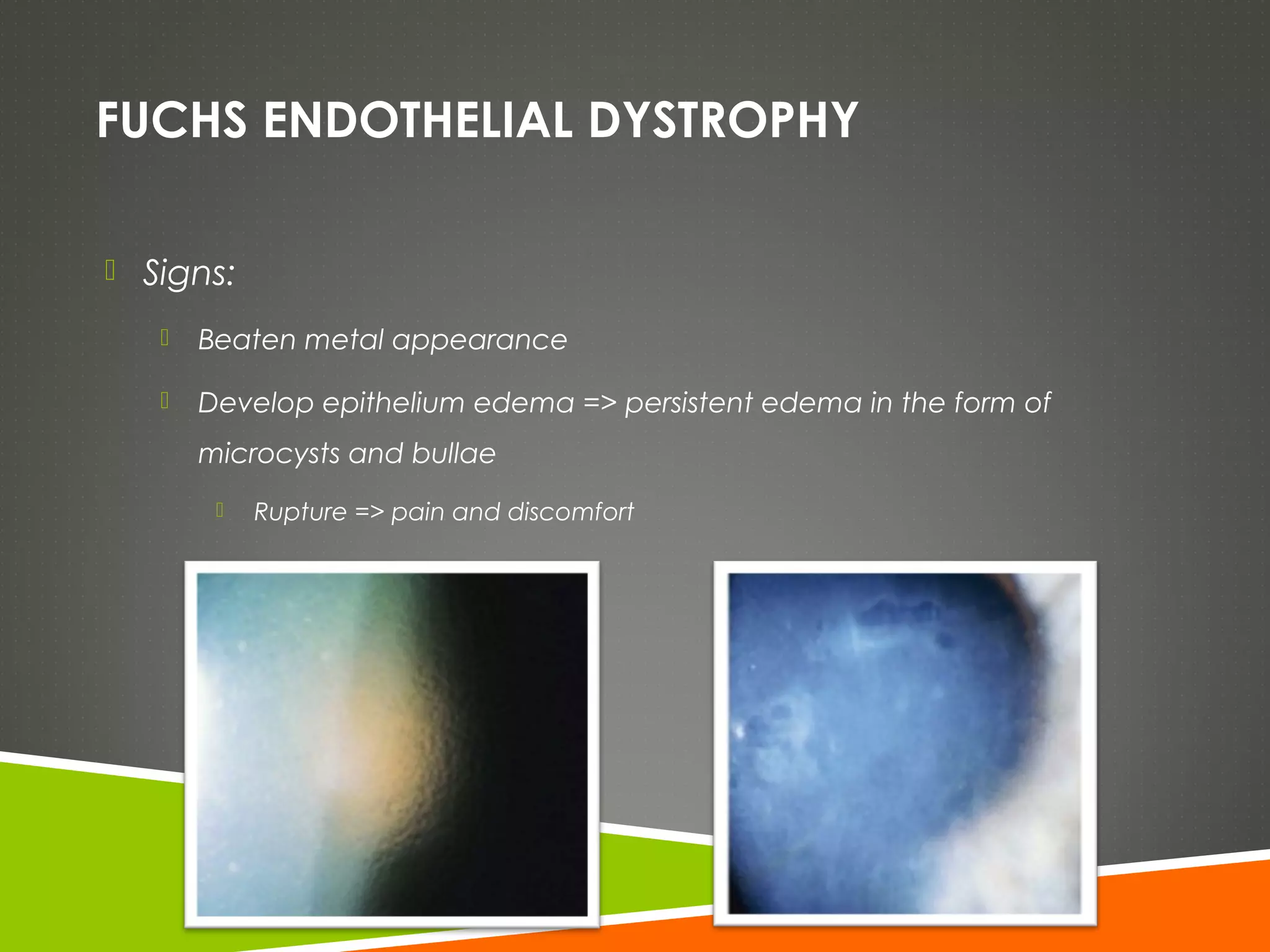 Fuchs dystrophy and pseudophakic bullous keratopathy | PPT