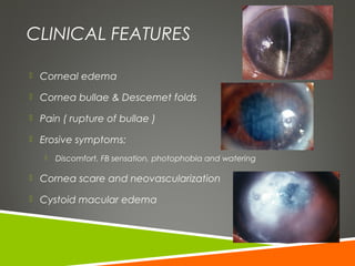 Fuchs dystrophy and pseudophakic bullous keratopathy | PPT