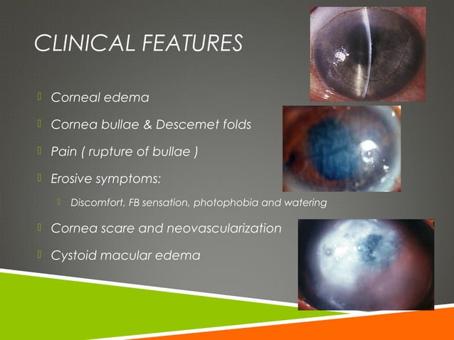 Fuchs dystrophy and pseudophakic bullous keratopathy | PPT | Eye and ...