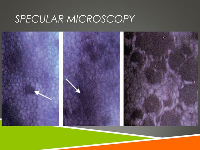 Fuchs dystrophy and pseudophakic bullous keratopathy | PPT | Eye and ...