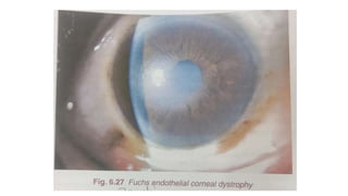 Fuchs endothelial corneal dystrophy.pptx