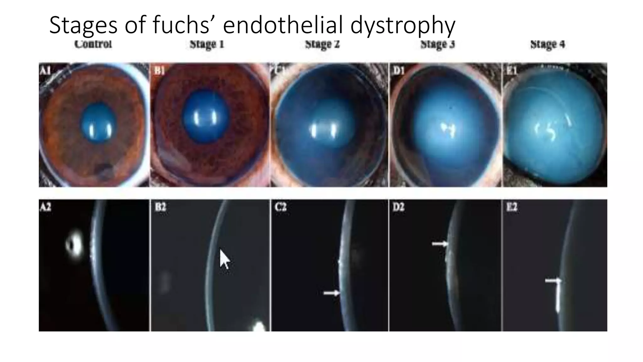 Fuchs endothelial dystrophy mahfuz.pptx
