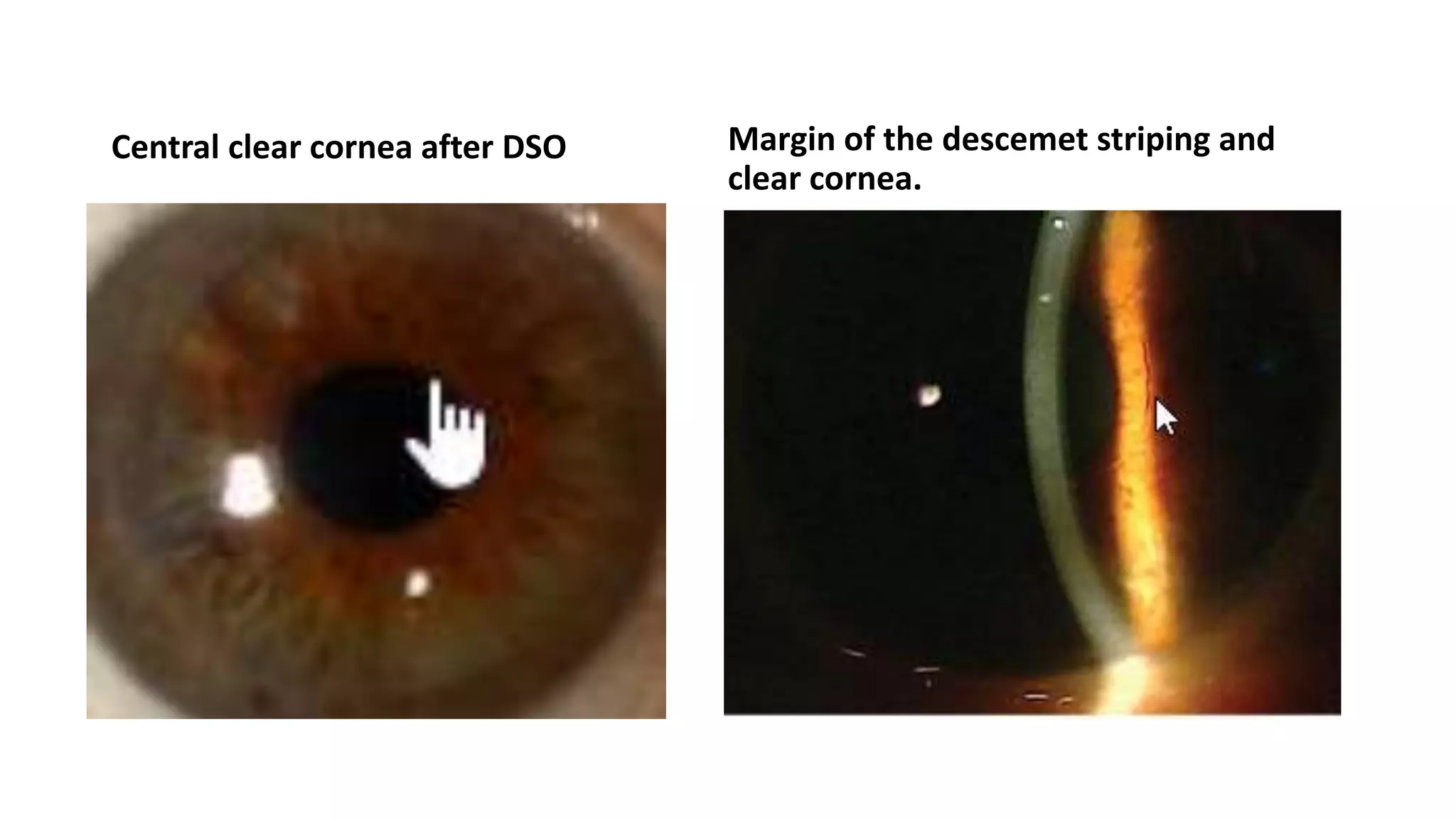 Fuchs endothelial dystrophy mahfuz.pptx