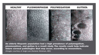Fuchs endothelial dystrophy mahfuz.pptx