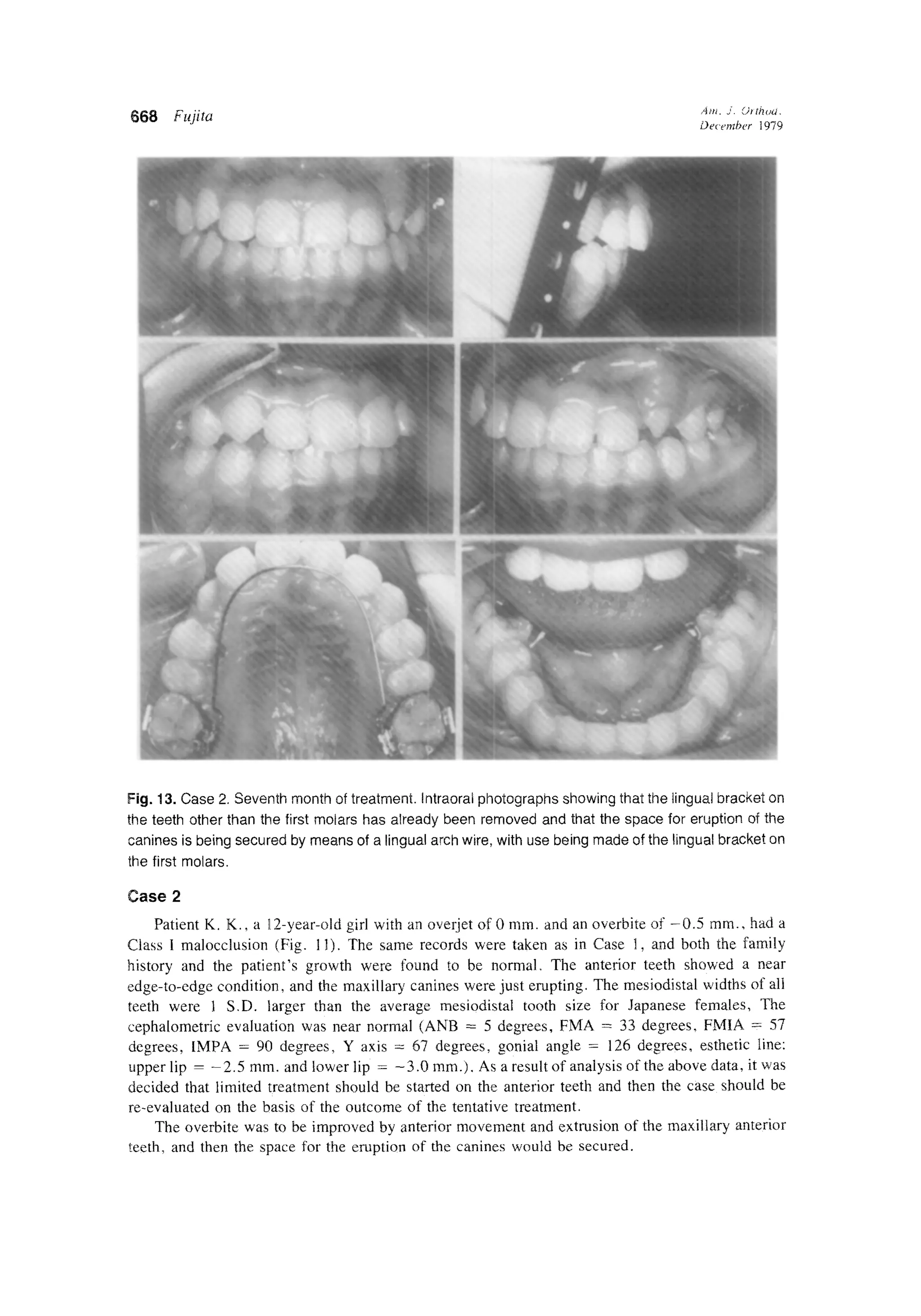 Fujita lingual orthodontics ajo article | PDF