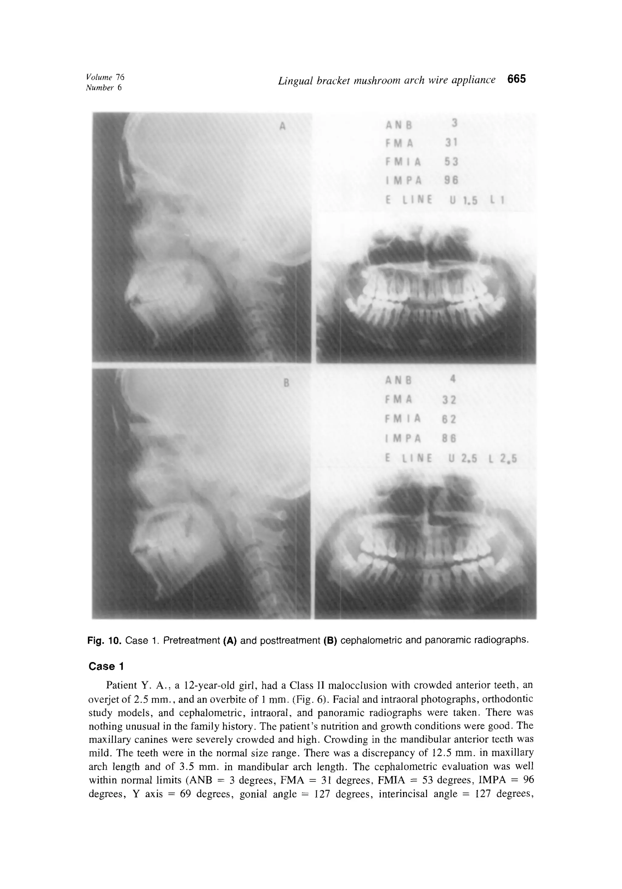 Fujita lingual orthodontics ajo article | PDF