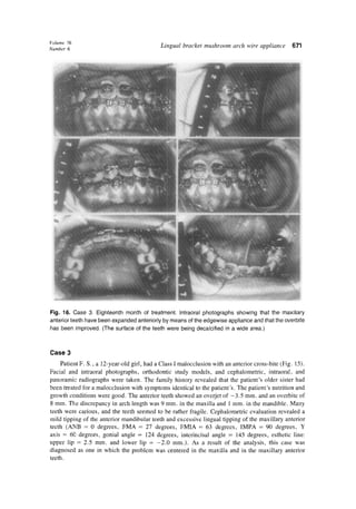 Fujita lingual orthodontics ajo article | PDF