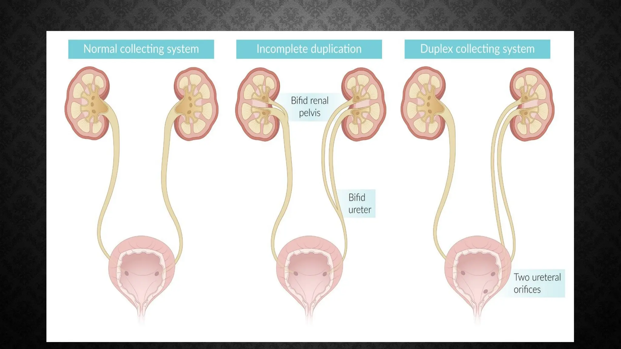 Duplex renal systemComplete/Partial Duplex Renal System, .pptx