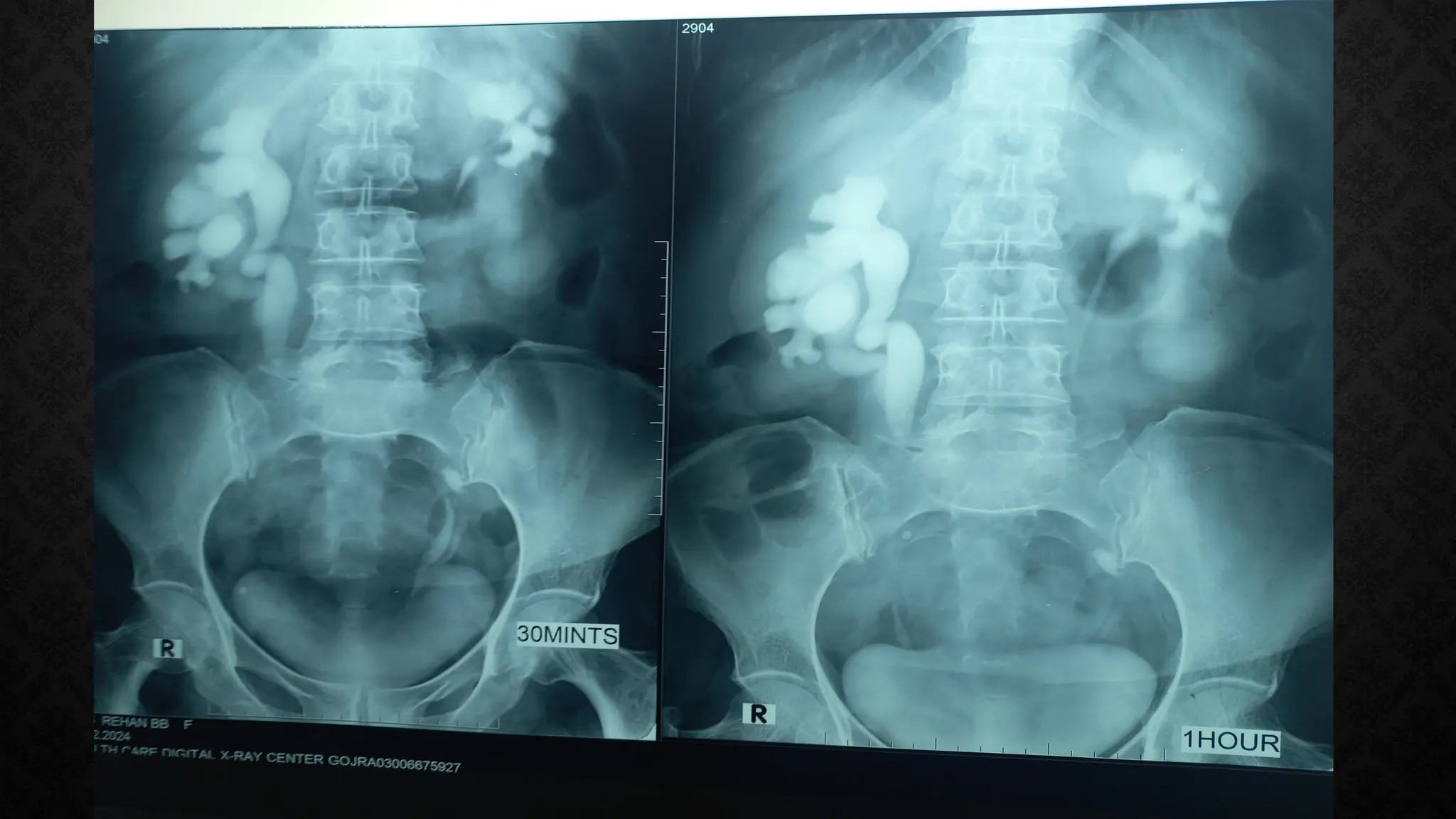 Duplex renal systemComplete/Partial Duplex Renal System, .pptx