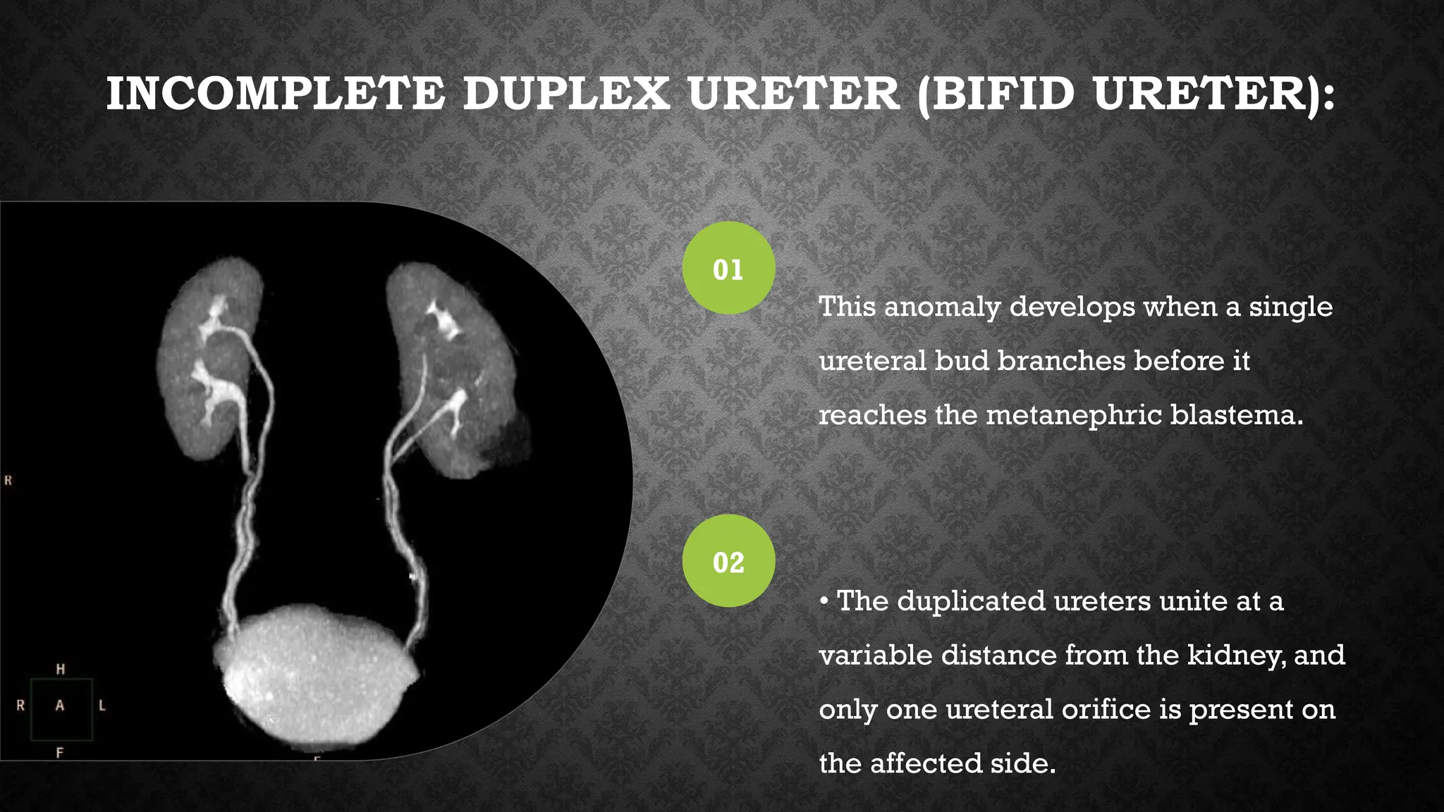 Duplex renal systemComplete/Partial Duplex Renal System, .pptx