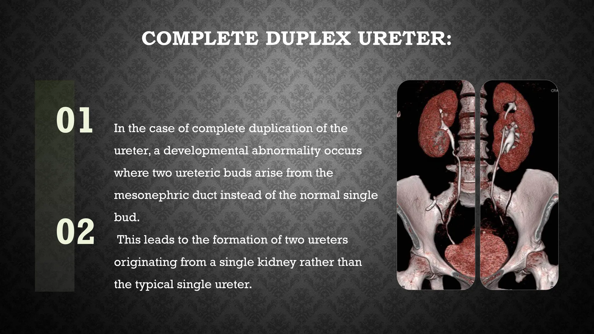 Duplex renal systemComplete/Partial Duplex Renal System, .pptx