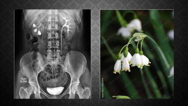 Duplex renal systemComplete/Partial Duplex Renal System, .pptx
