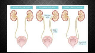 Duplex renal systemComplete/Partial Duplex Renal System, .pptx