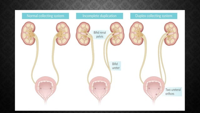 Duplex renal systemComplete/Partial Duplex Renal System, .pptx