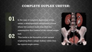 Duplex renal systemComplete/Partial Duplex Renal System, .pptx