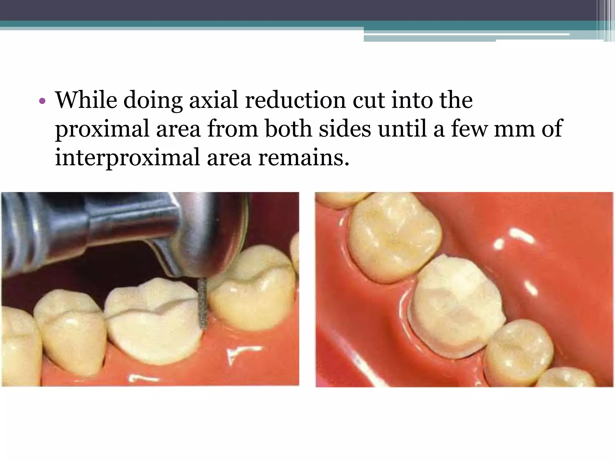 full coverage restorations.pptx