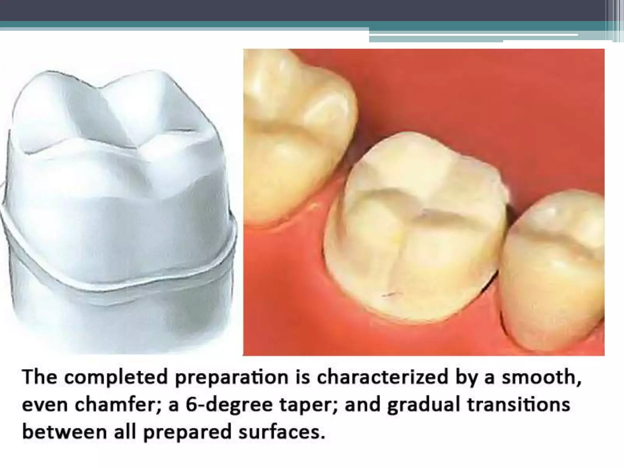 full coverage restorations.pptx