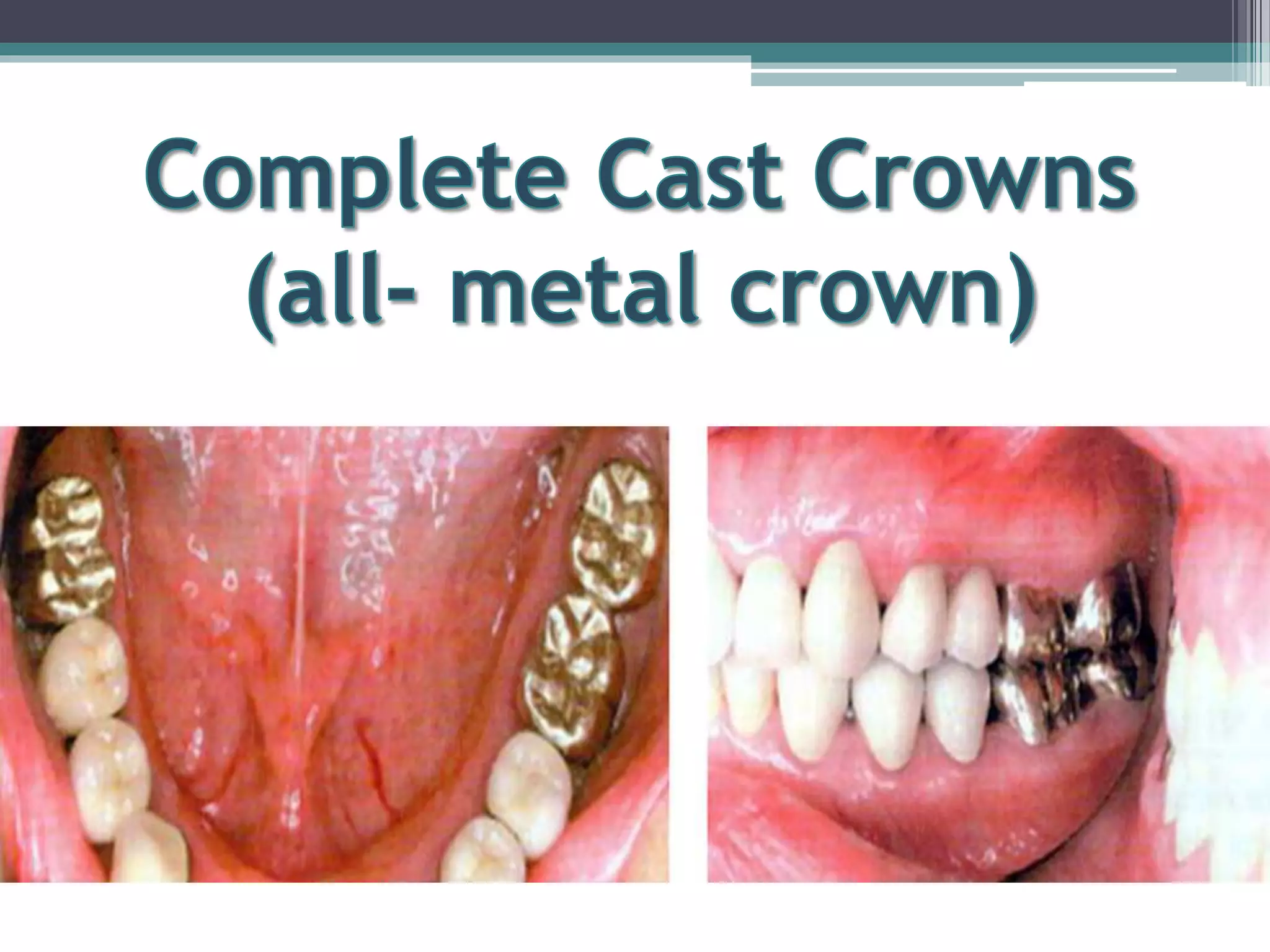 full coverage restorations.pptx