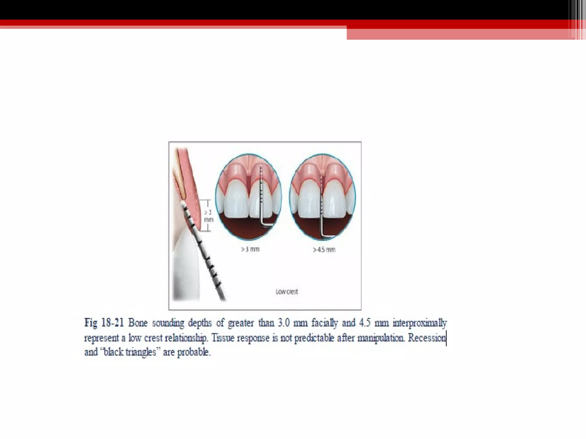 Full crown preparation | PPT