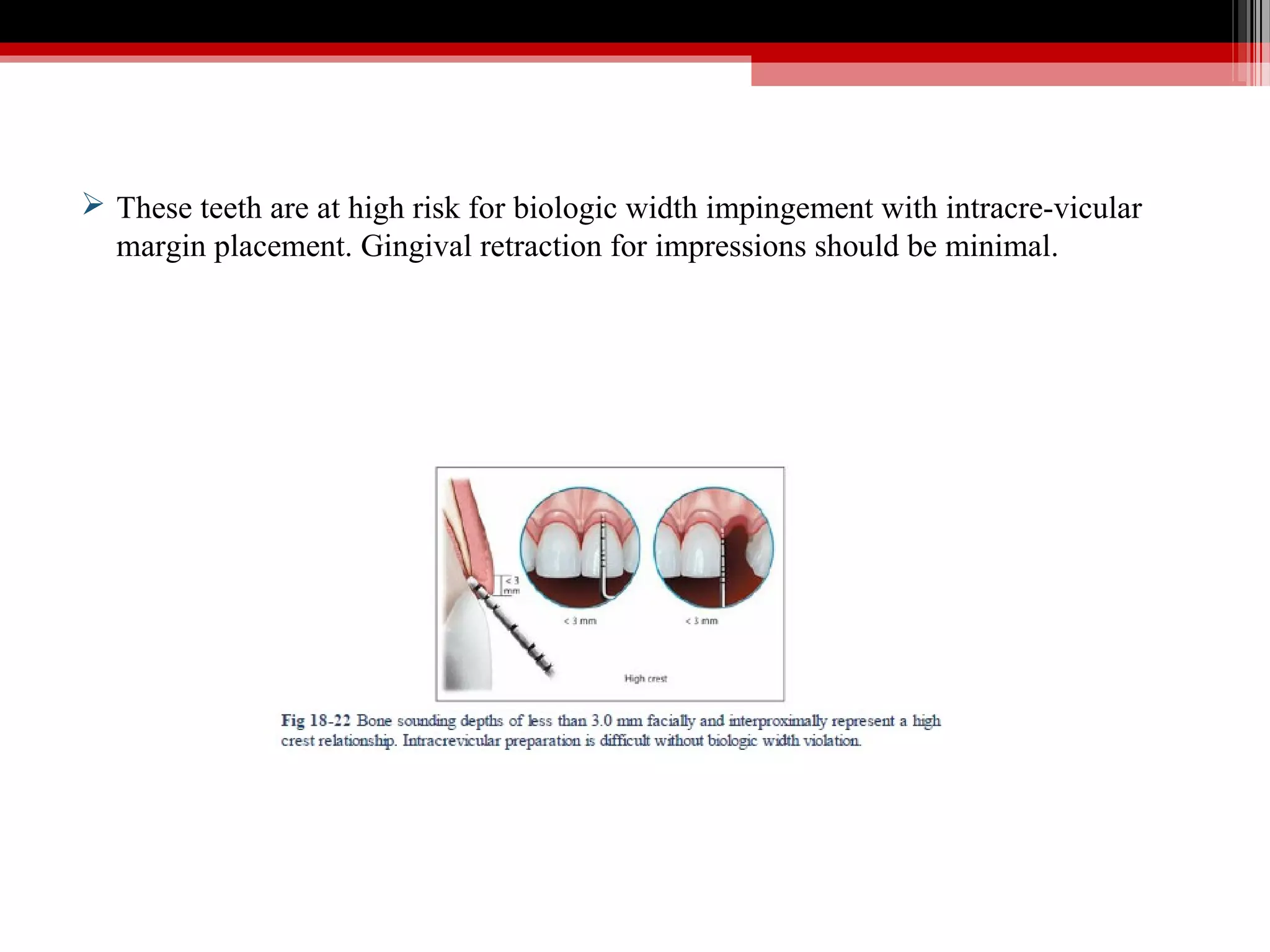 Full crown preparation | PPT