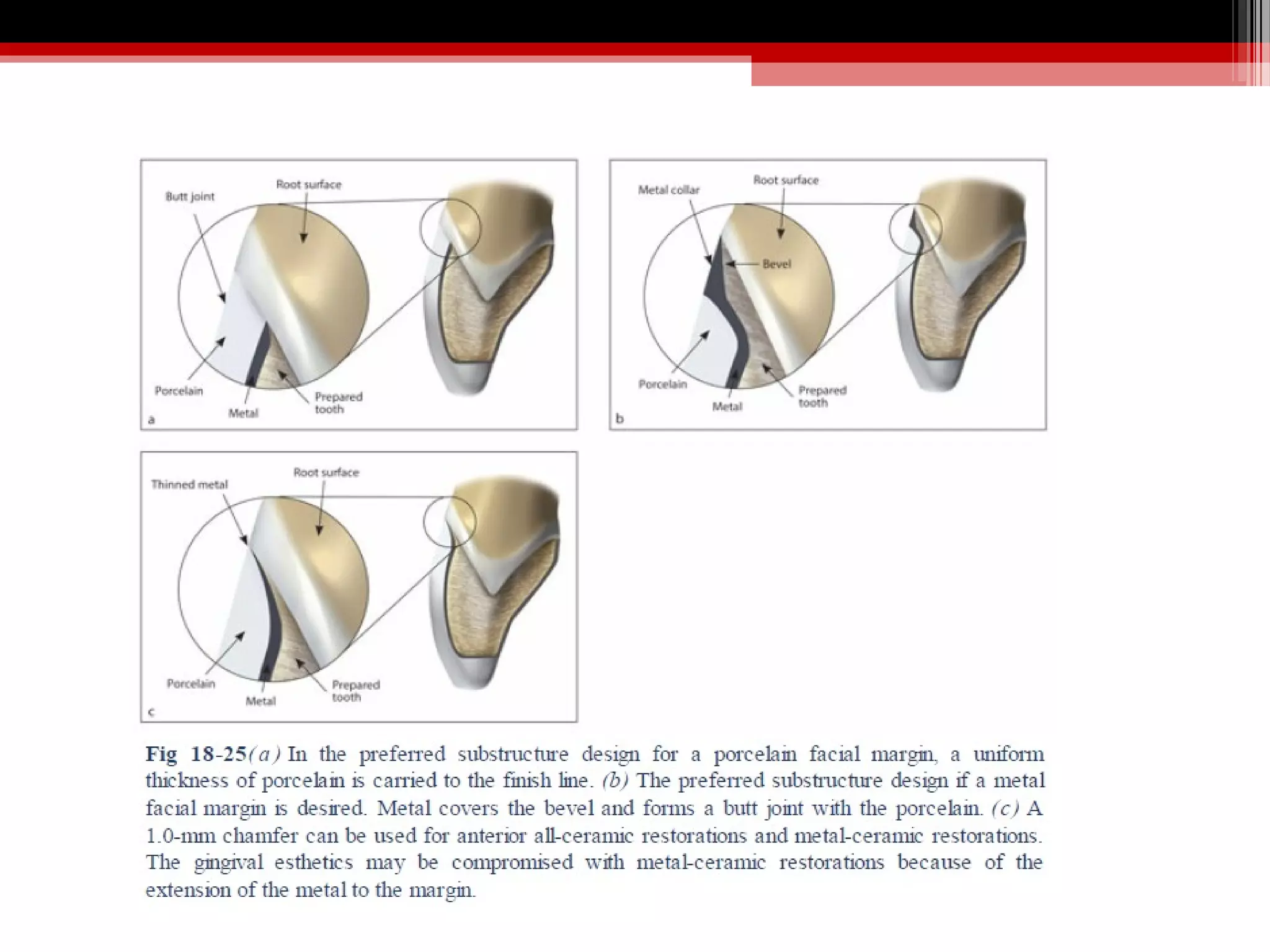 Full crown preparation | PPT