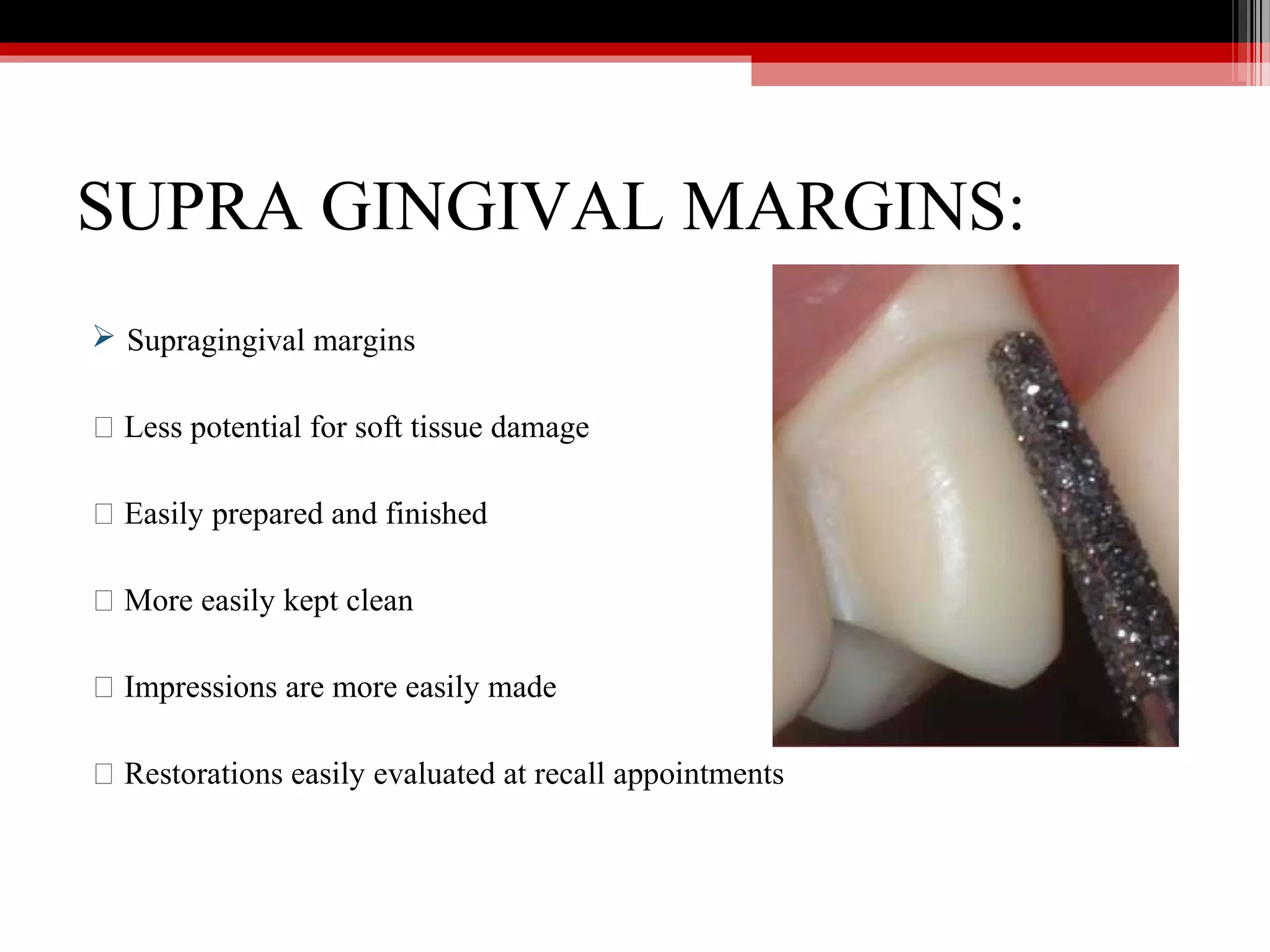 Full crown preparation | PPT