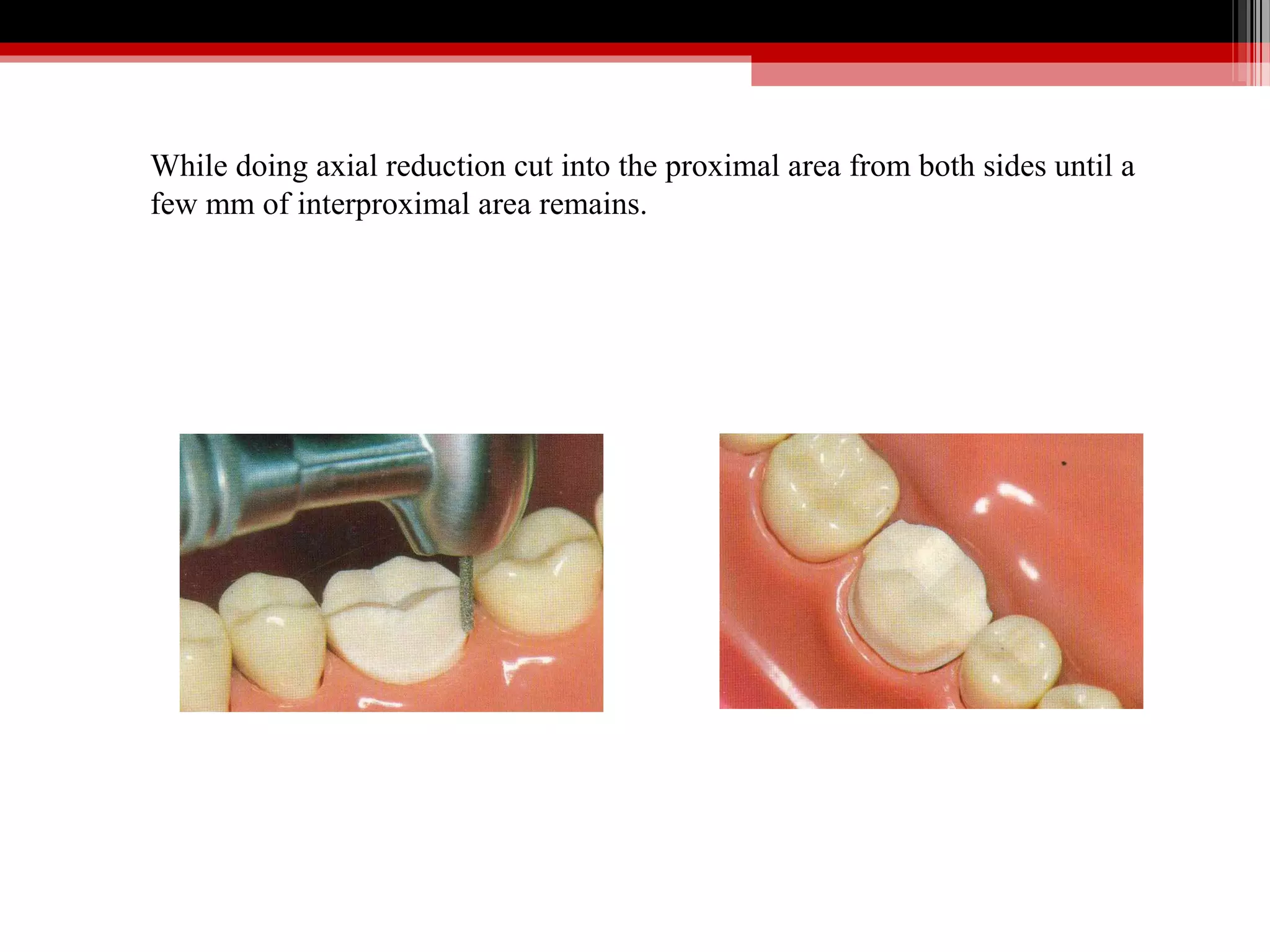 Full crown preparation | PPT