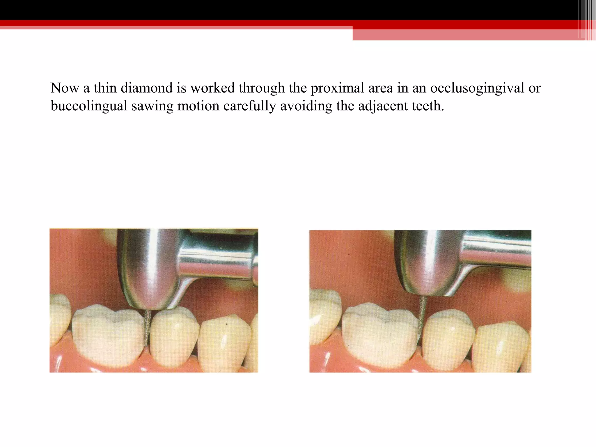 Full crown preparation | PPT