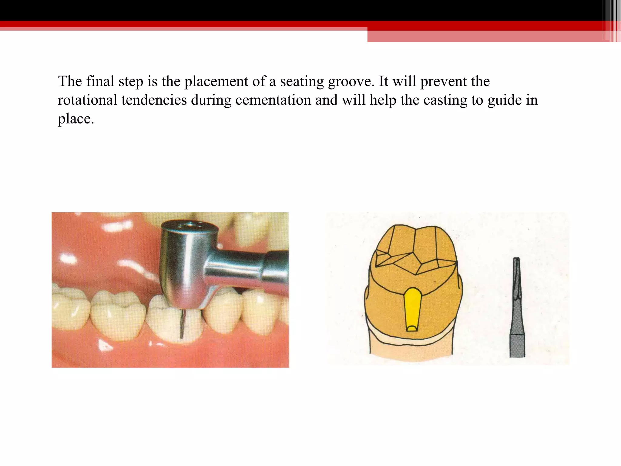 Full crown preparation | PPT