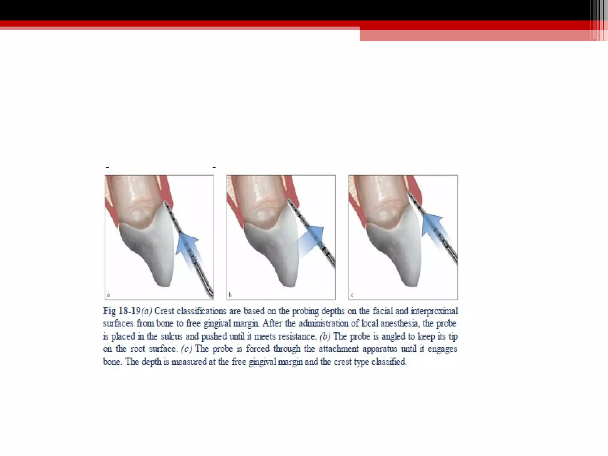 Full crown preparation | PPT | Dental Health | Diseases and Conditions