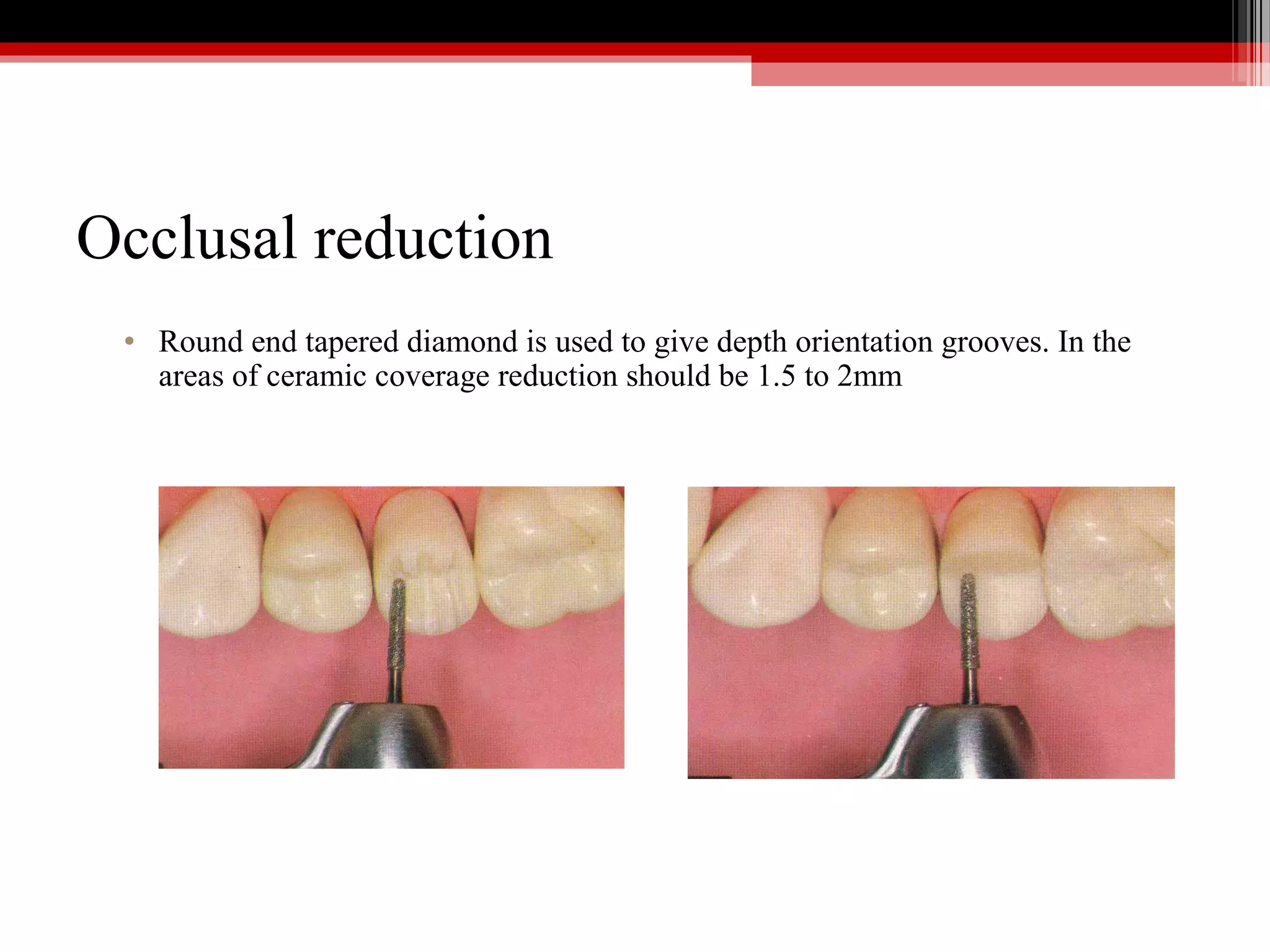 Full crown preparation | PPT