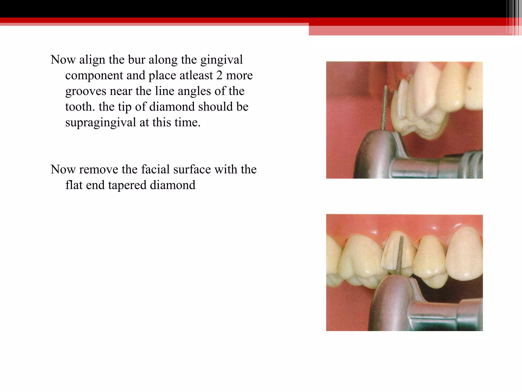 Full crown preparation | PPT