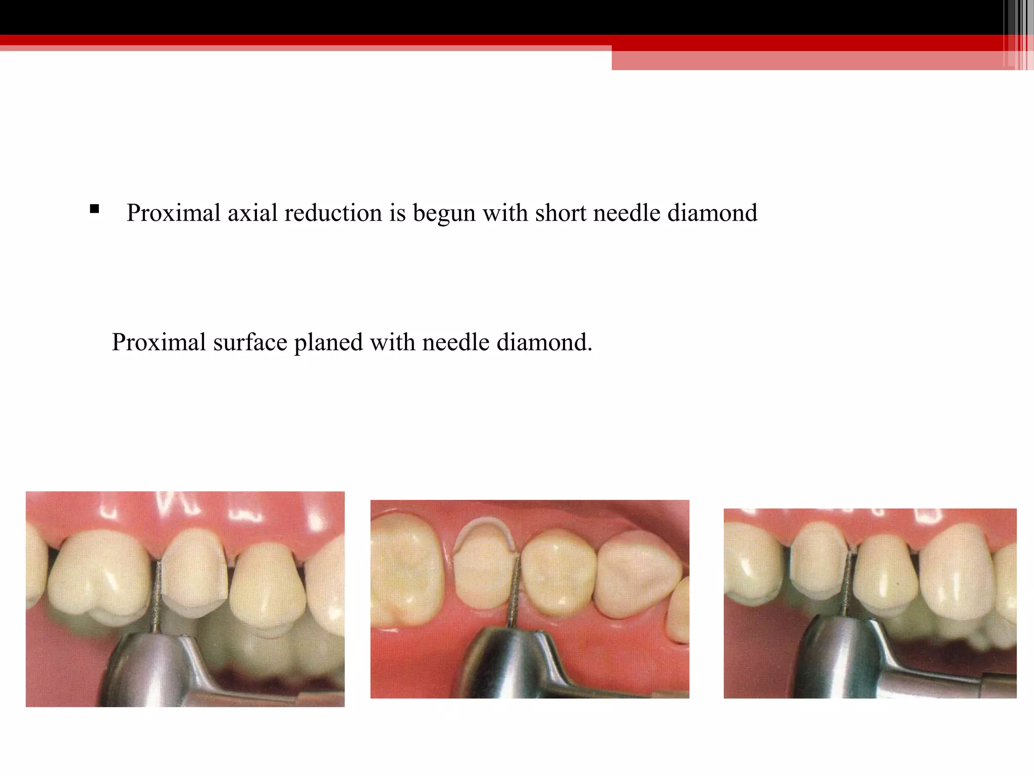 Full crown preparation | PPT