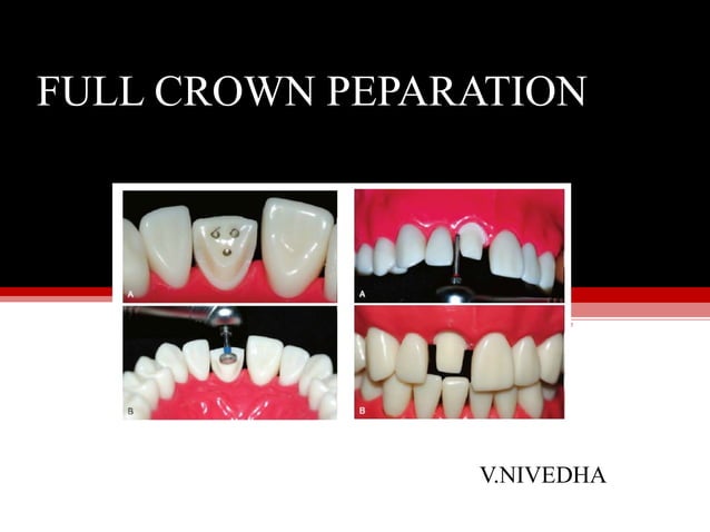 Full crown preparation | PPT | Dental Health | Diseases and Conditions