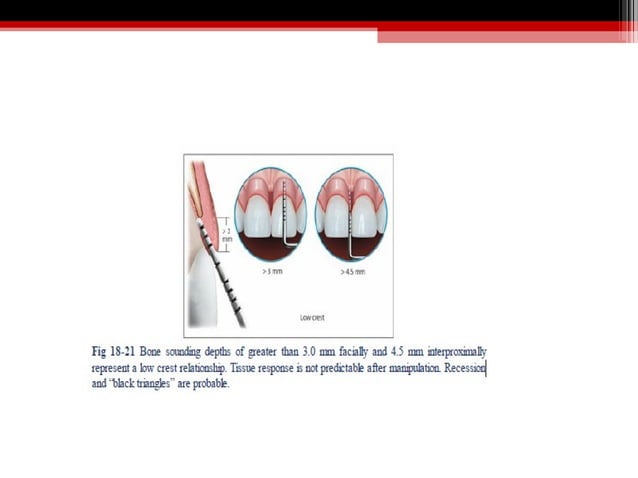 Full crown preparation | PPT | Dental Health | Diseases and Conditions