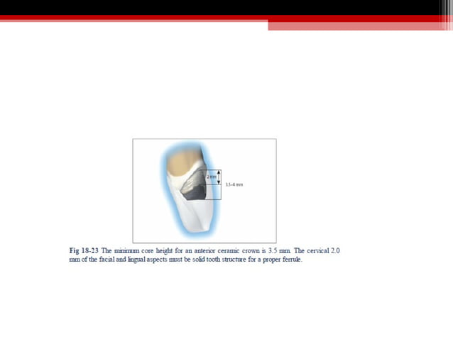 Full crown preparation | PPT | Dental Health | Diseases and Conditions