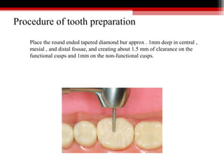 Full crown preparation | PPT